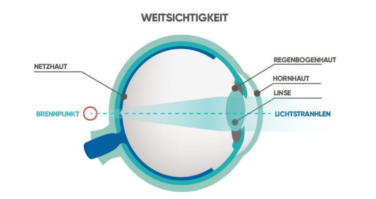 Weitsichtigkeit lasern: Fehlsichtigkeit korrigieren | Lasik Care