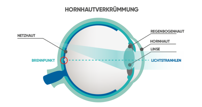 Hornhautverkrümmung lasern - Behandlung ist möglich | Lasik Care